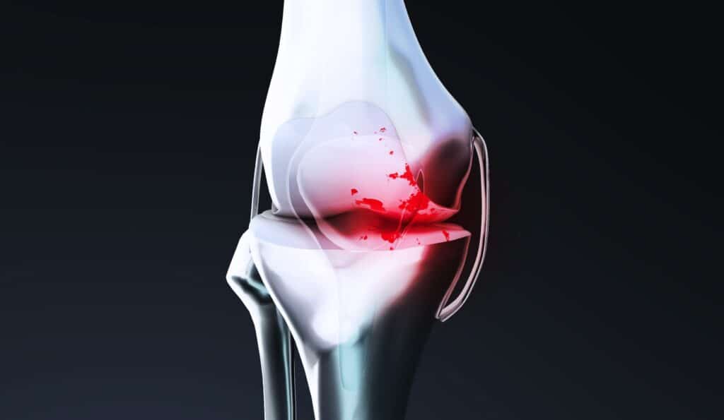 Chondropathie : causes et traitements | Dr Polle | Normandie