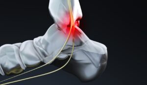 Syndrome du canal tarsien : traitement | Dr Polle | Bois-Guillaume