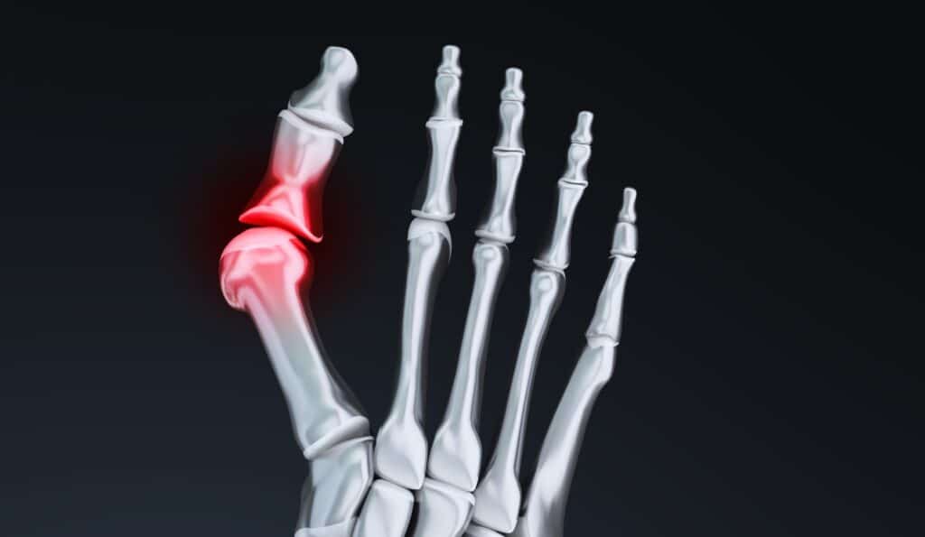 Arthrodèse du Lisfranc, chirurgie du pied | Normandie | Dr Polle