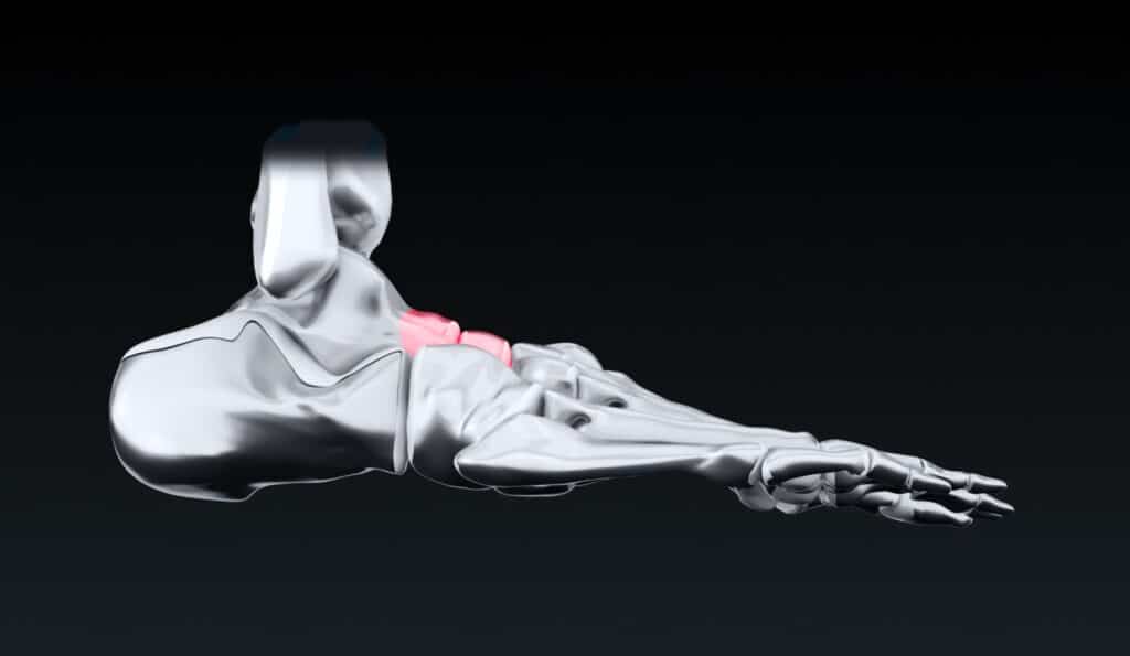 Arthrodèse talo-naviculaire, chirurgie pied | Normandie | Dr Polle