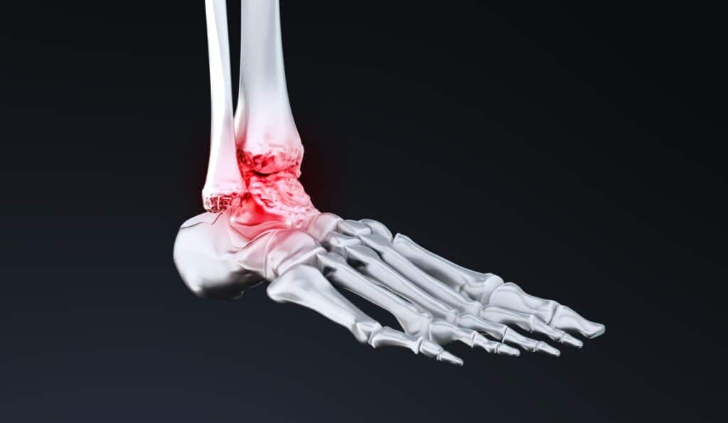 Arthrose de la cheville : cause et traitement | Dr Polle | Normandie