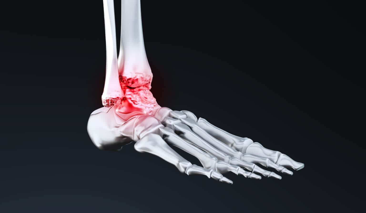 Arthrose de la cheville : cause et traitement | Dr Polle | Normandie