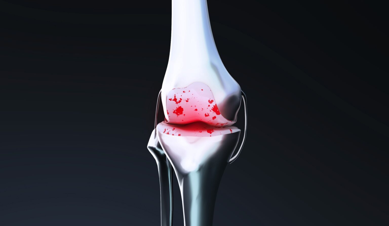 Arthrose du genou : causes et traitements | Dr Polle | Normandie
