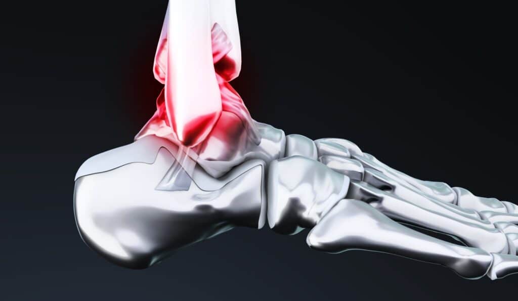 Entorse de la cheville : causes et traitements | Dr Polle | Normandie