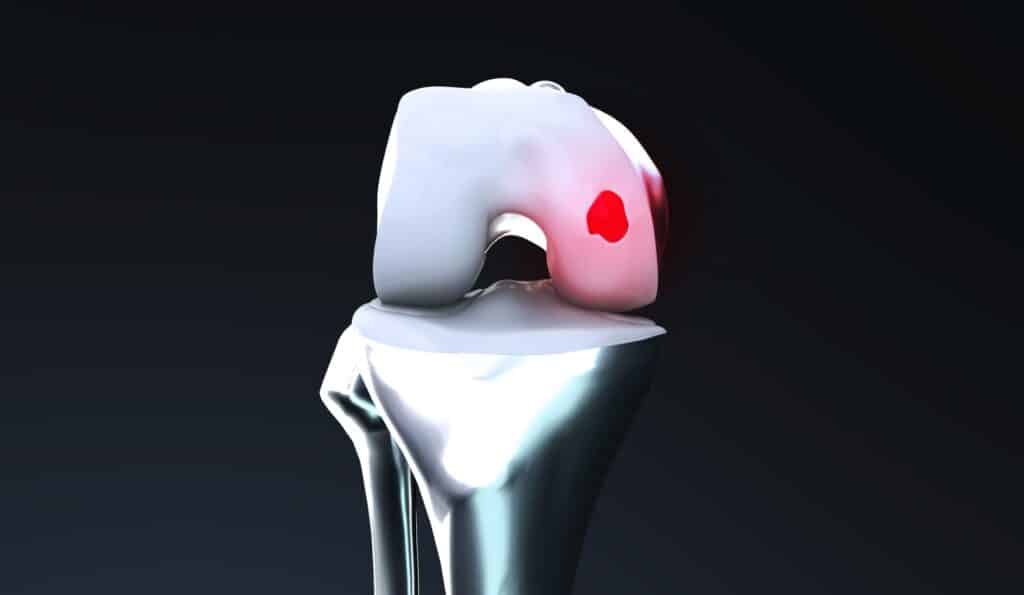 Lésion cartilagineuse : cause et traitement | Dr Polle | Bois-Guillaume