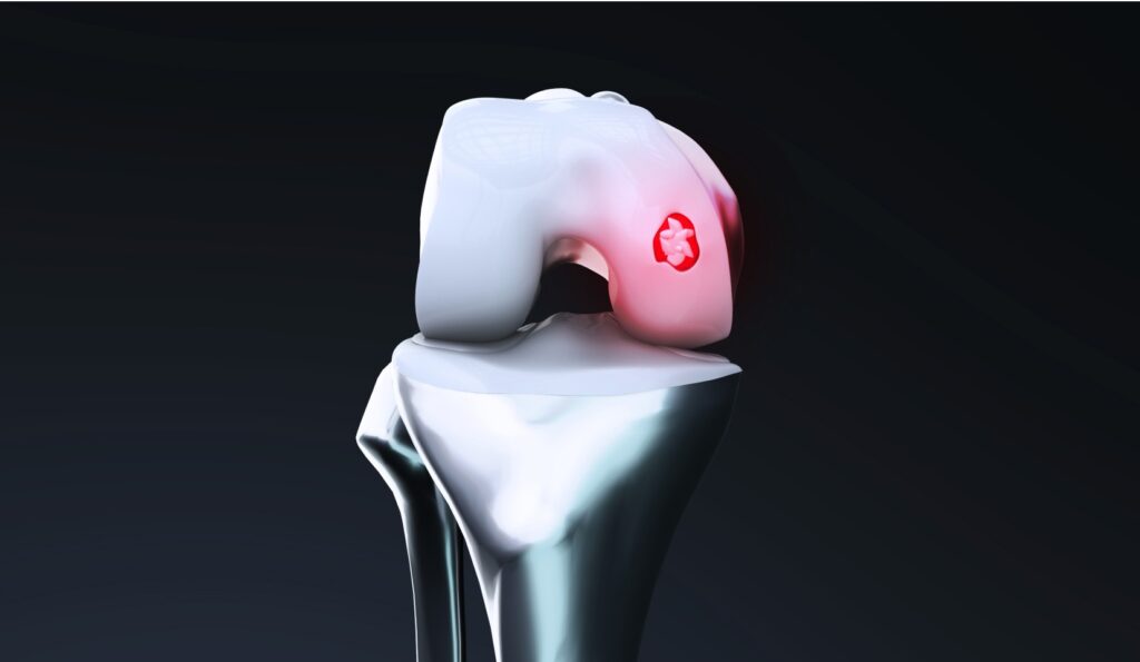 Ostéochondrite du genou : traitement | Dr Polle | Bois-Guillaume