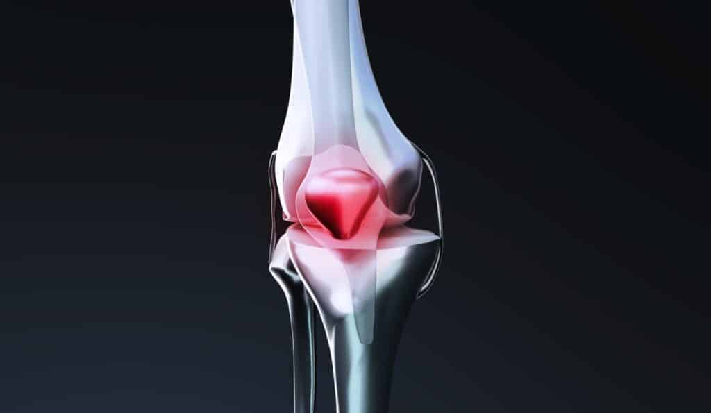 Recentrage rotulien : chirurgie du genou | Bois-Guillaume | Dr Polle