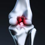 Rupture du ligament croisé : cause et traitement | Dr Polle | Bois ...