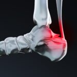 Pathologies de la cheville, orthopédiste | Dr Polle | Bois-Guillaume