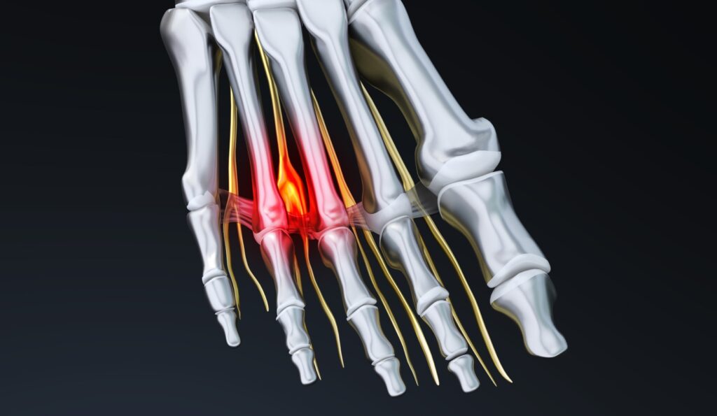 Syndrome de Morton : cause et traitement | Dr Polle | Bois-Guillaume