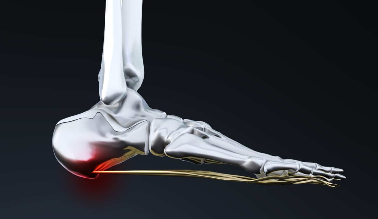 Talalgies et épines calcanéennes | Dr Polle | Bois-Guillaume