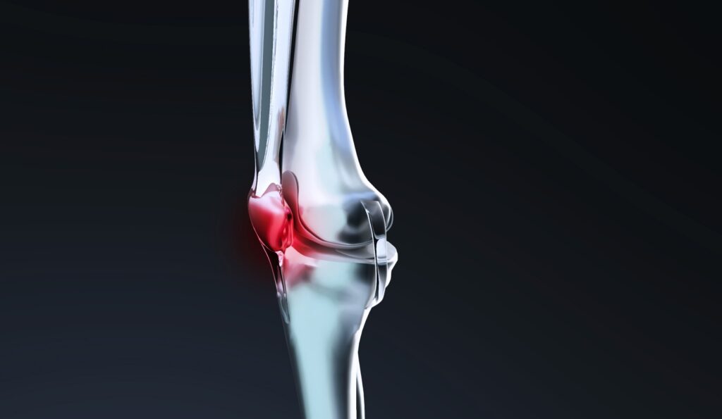 Tendinite du tendon rotulien : traitement | Dr Polle | Bois-Guillaume