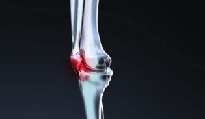 Tendinite du tendon rotulien : traitement | Dr Polle | Bois-Guillaume