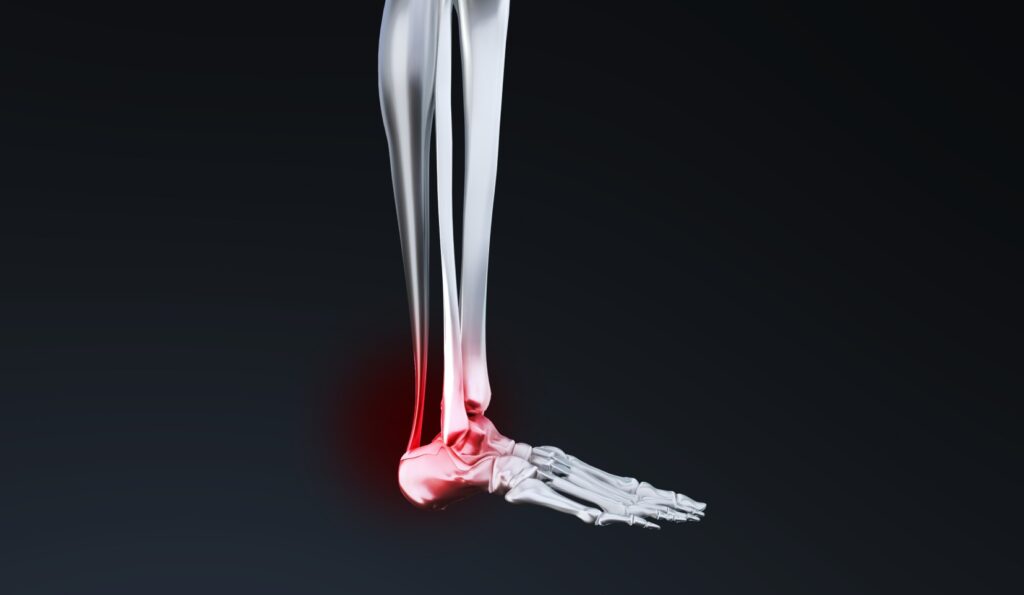 Tendinopathie des fibulaires : traitement | Dr Polle | Bois-Guillaume