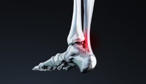 Pathologies de la cheville, orthopédiste | Dr Polle | Bois-Guillaume