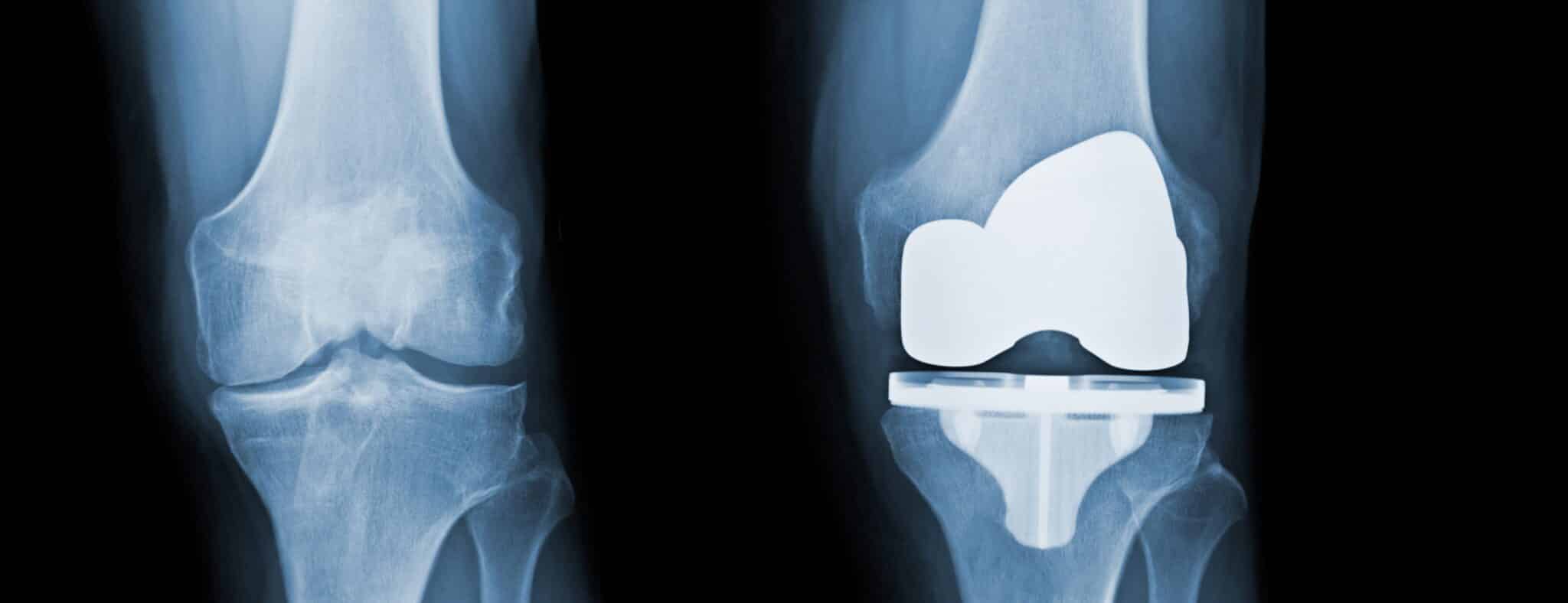 Quels sports ne peut-on pas pratiquer avec une prothèse de genou ? |Dr ...