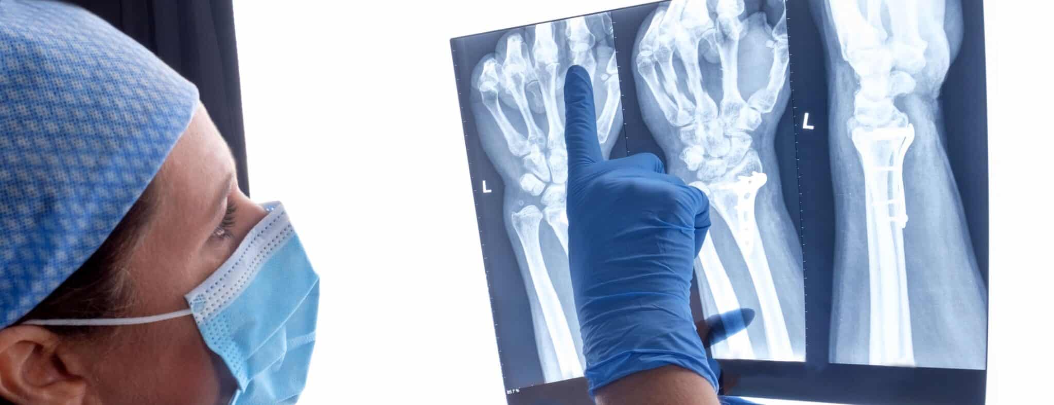 Les fractures osseuses : traitement et rôle de la chirurgie ...