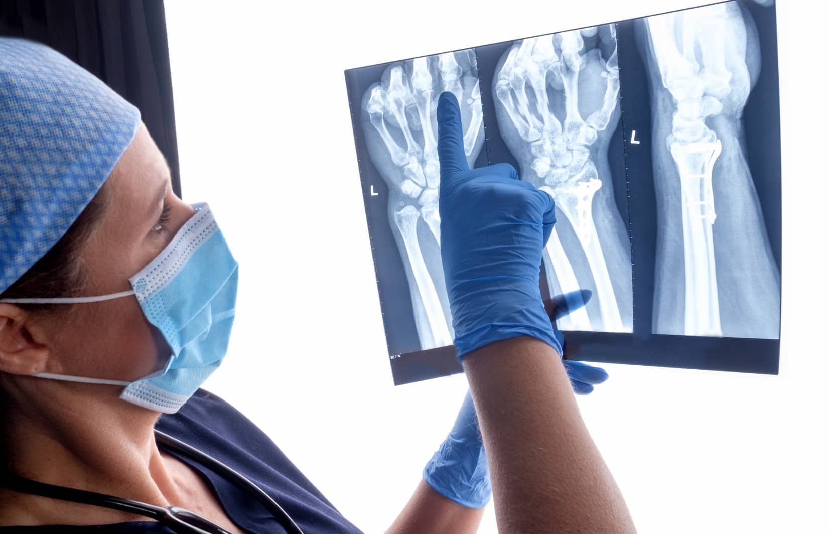 Les fractures osseuses : traitement et rôle de la chirurgie ...