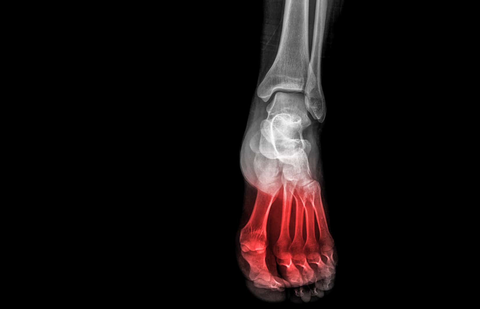 Quelles sont les causes et traitements des fractures de fatigue ? |Dr ...